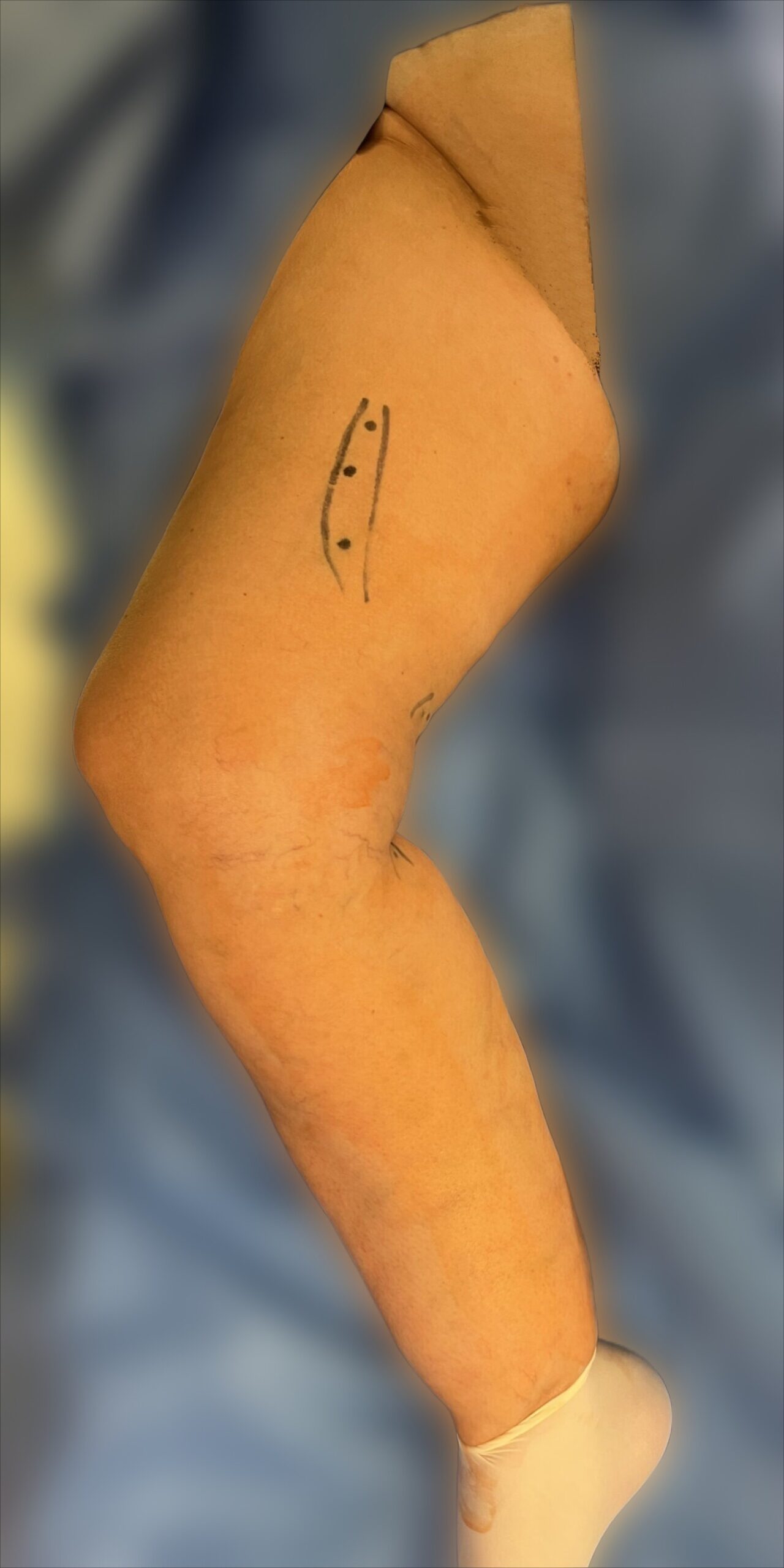 How to diagnose Lipedema | Lipedema Vascular
